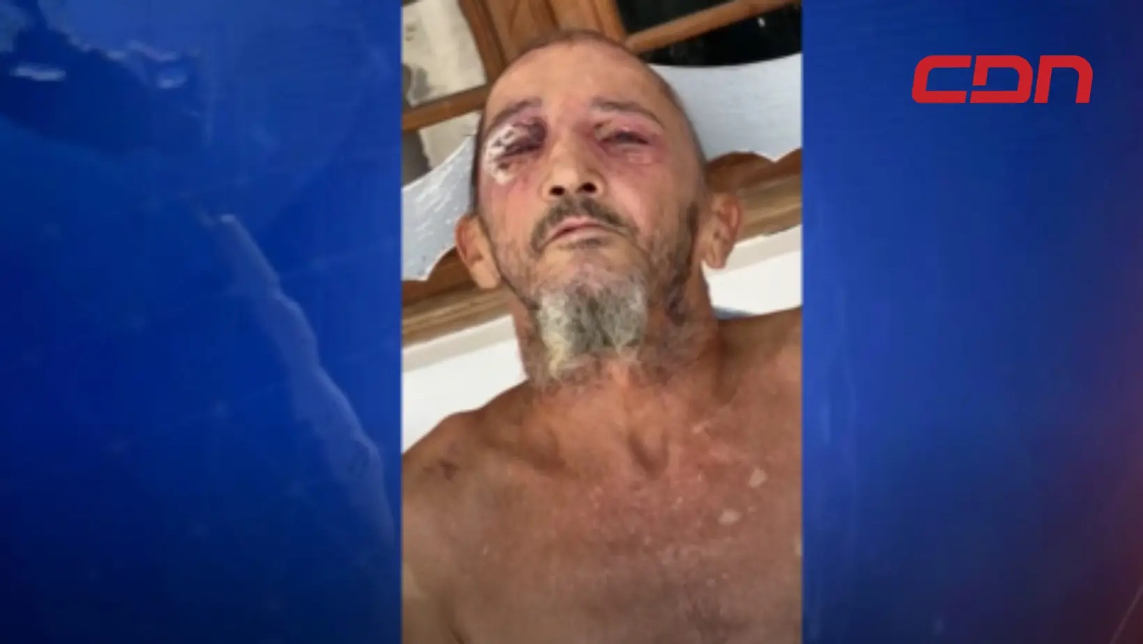 Hospitalizan hombre atacado supuestamente con ácido del diablo