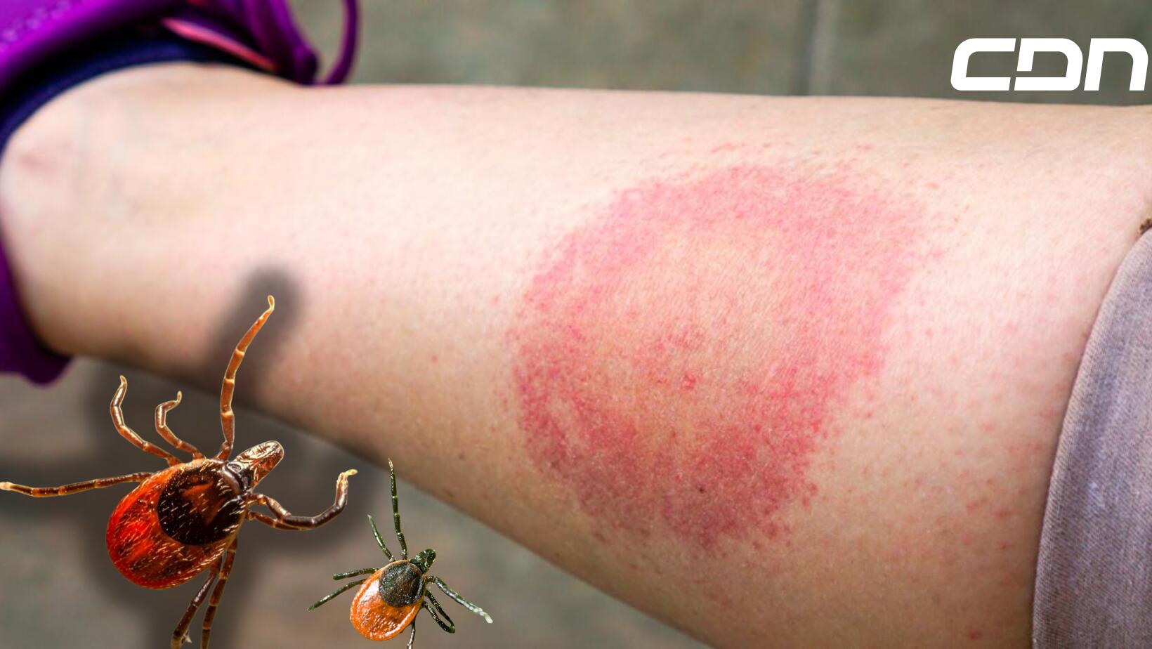 Enfermedad de Lyme: síntomas, causas y prevención