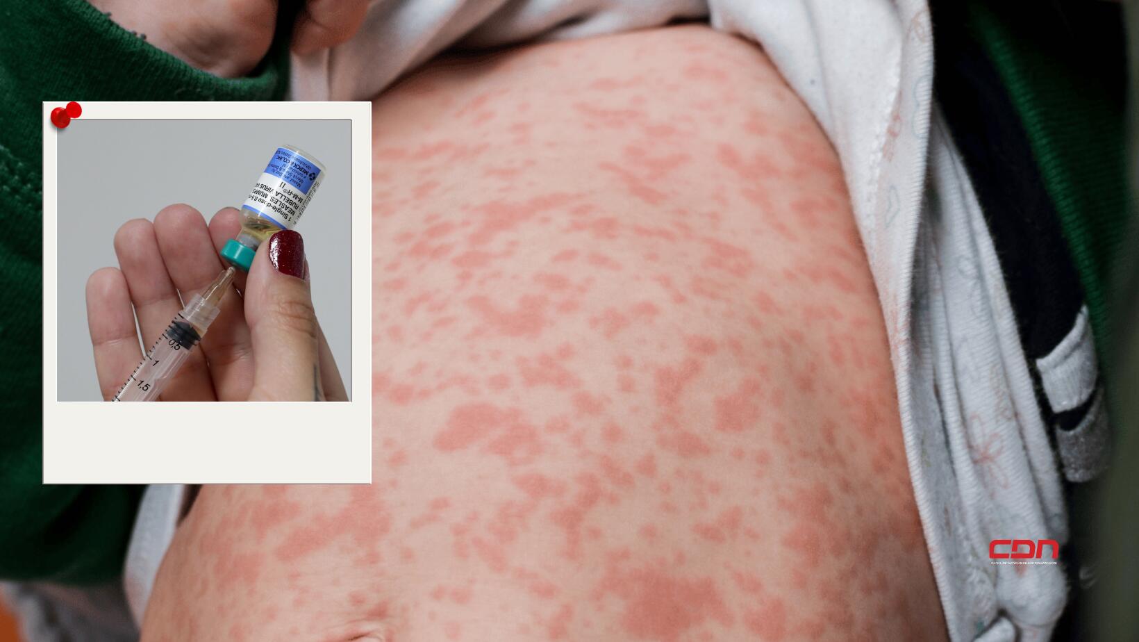 Sarampión: identificación, prevención y manejo