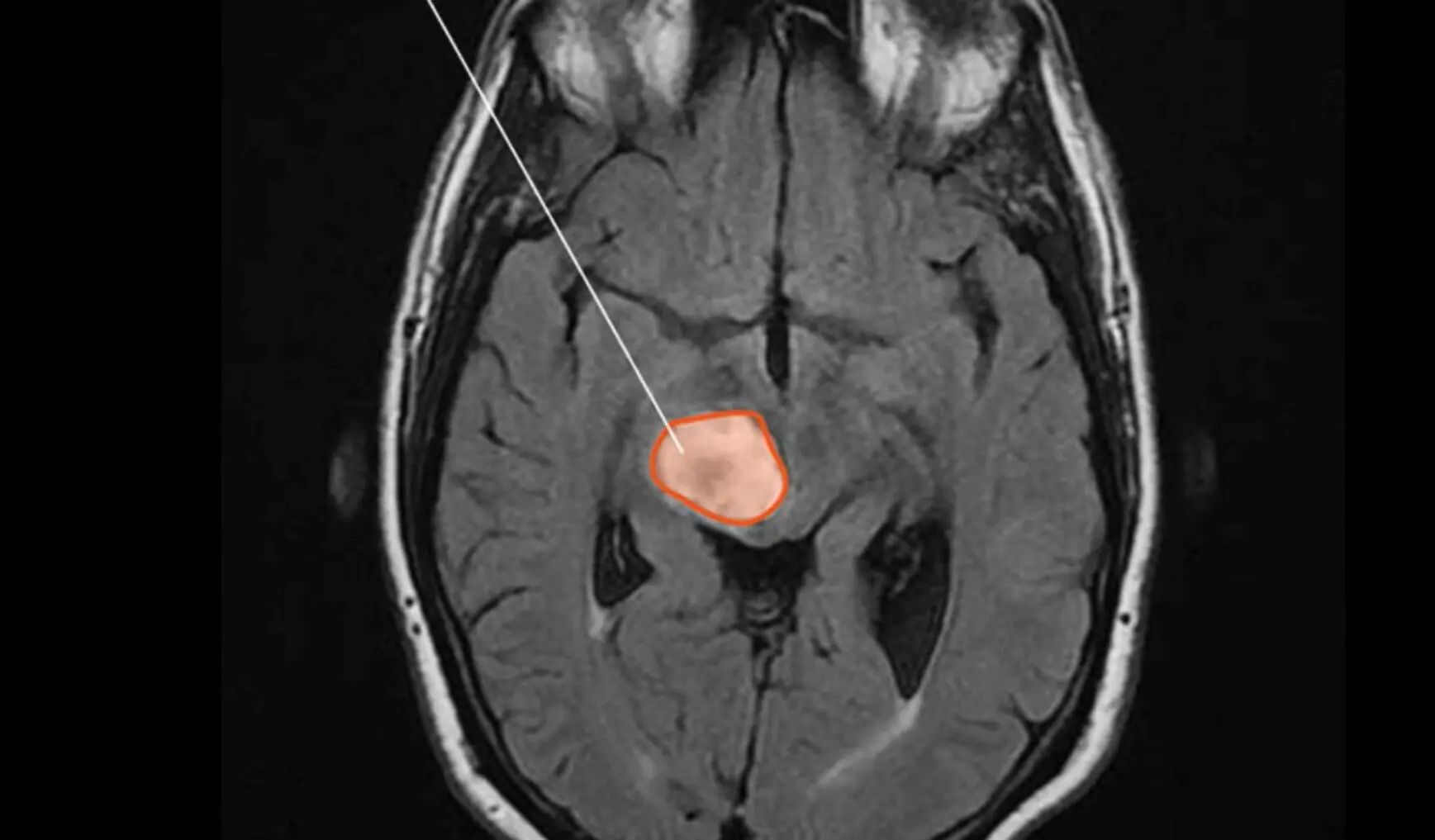 Glioma difuso de línea media: características principales