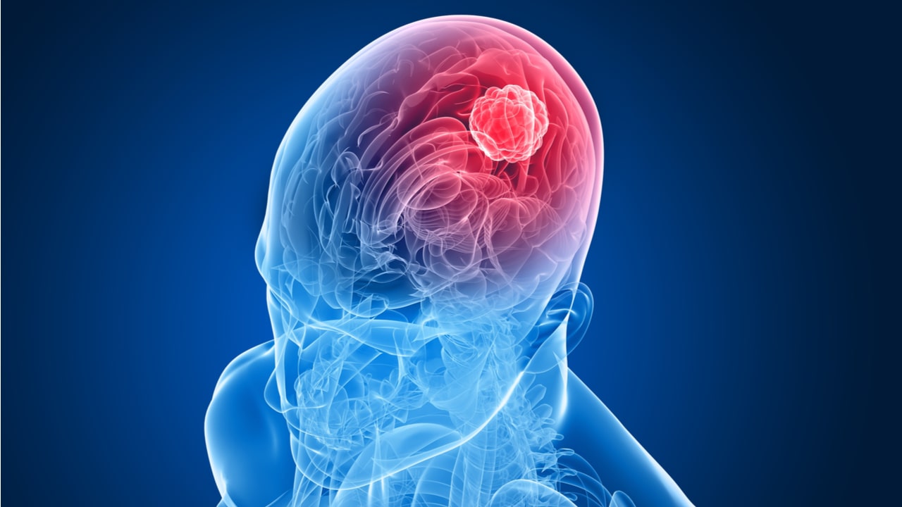 Sarcoma: ¿qué es, cuáles son sus riesgos y tratamientos?