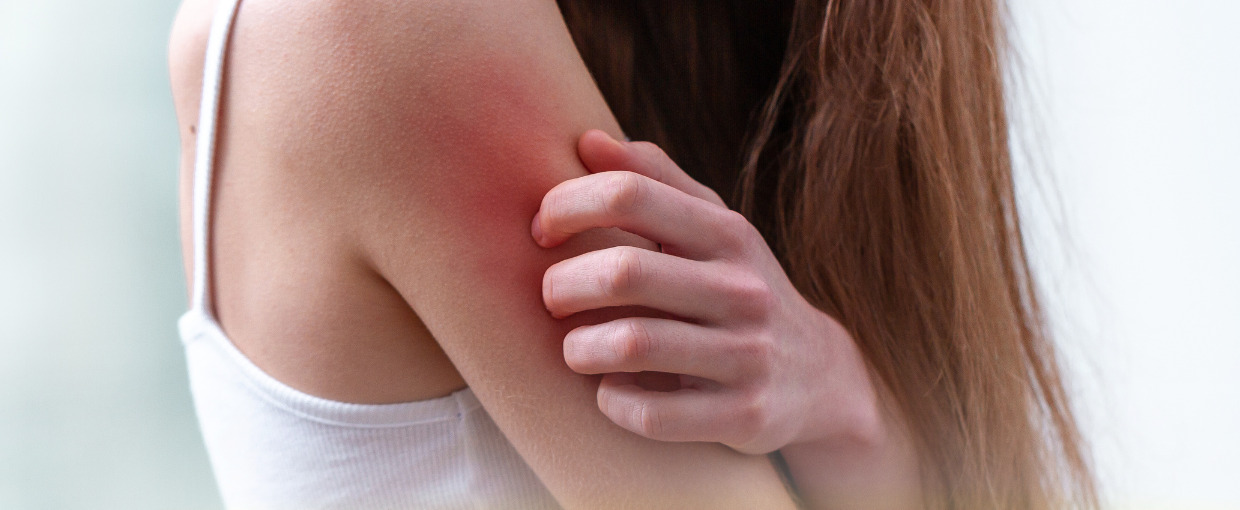 Infecciones bacterianas en la piel: ¿Cómo cuidarme?